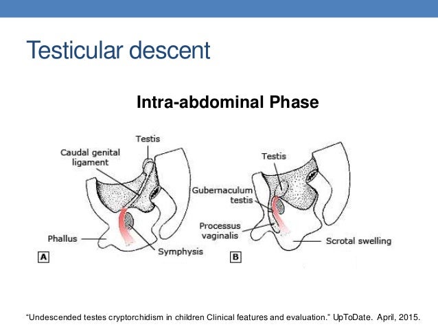 Cryptorchidism Undescended Testes