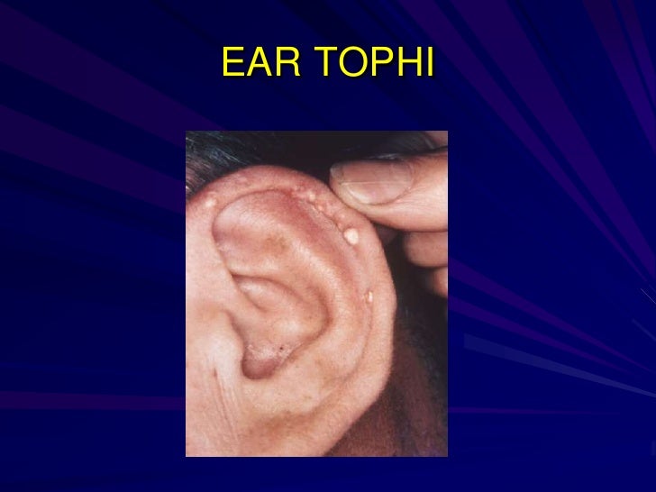 Crystal Arthritis Amh