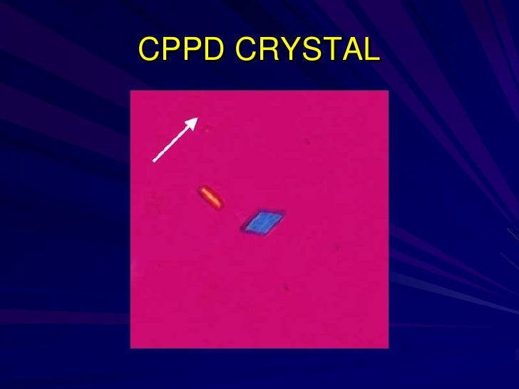 Crystal Arthritis Amh