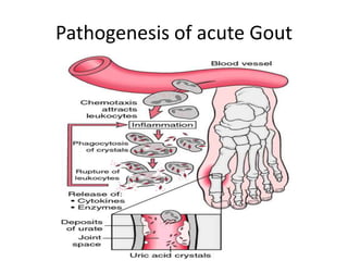 Crystal arthropathies gout & pseudogout | PPTX
