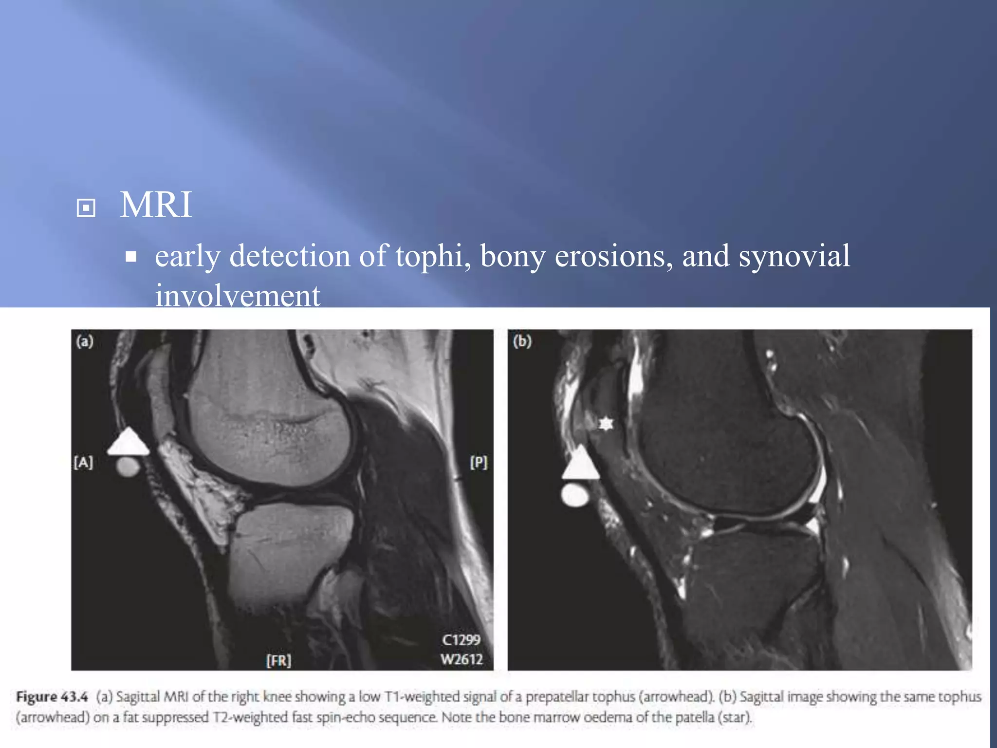 Crystal arthropathy.pptx