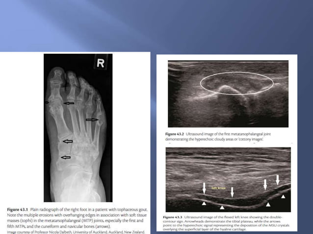 Crystal arthropathy.pptx