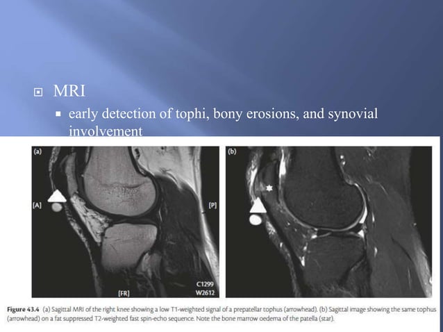 Crystal arthropathy.pptx