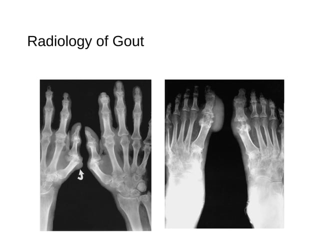 Crystal induced arthritis - Carlin | PPT | Foot Health | Diseases and ...
