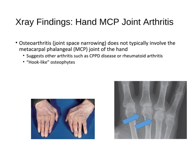 Crystal induced arthritis - Carlin | PPT | Foot Health | Diseases and ...