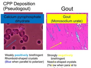 Crystal induced arthritis - Carlin | PPT