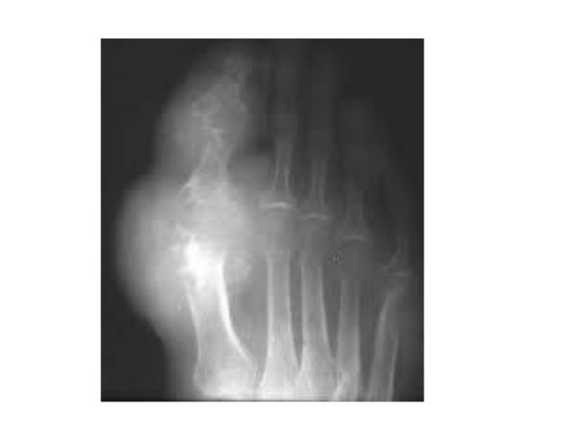 Crystal induced arthropathy | PDF | Bone and Joint Conditions ...