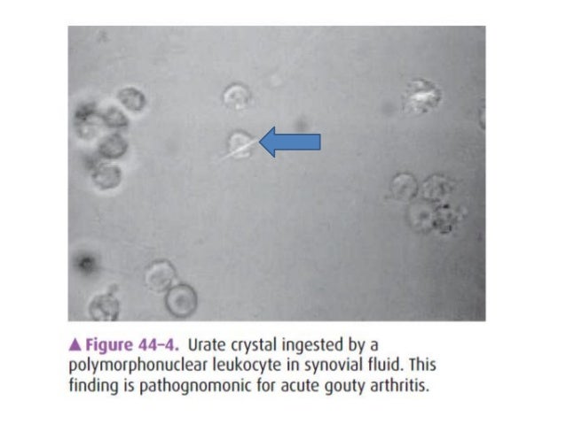 Crystal induced arthropathy | PDF | Bone and Joint Conditions ...