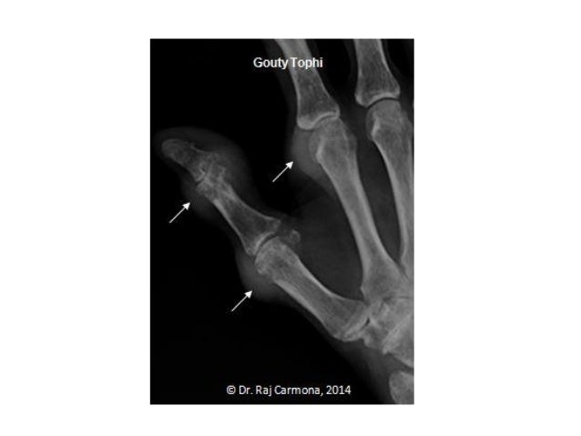 Crystal induced arthropathy | PDF | Bone and Joint Conditions ...