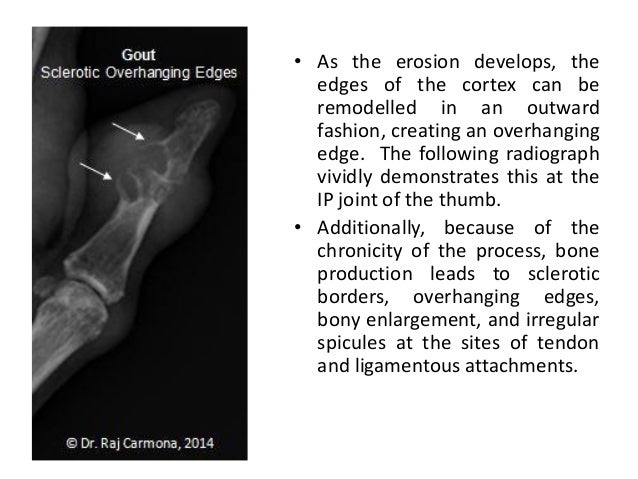 Crystal induced arthropathy | PDF | Bone and Joint Conditions ...