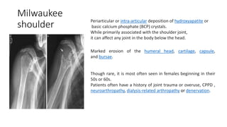 Crystals in rheumatic diseases.pptx
