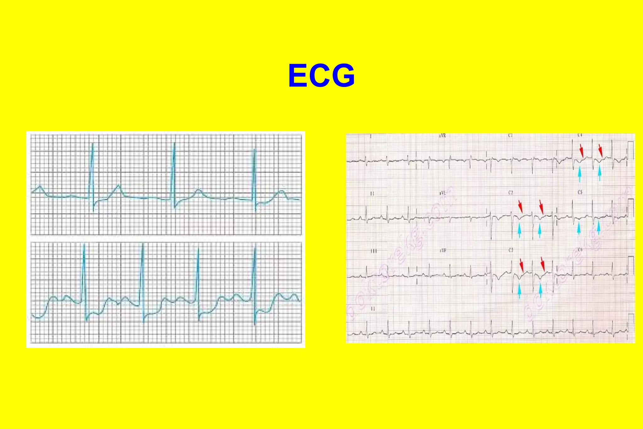 Chronic Stable Angina- Diagnosis & management | PPT