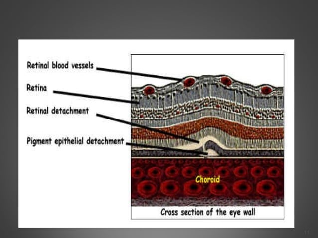 CENTRAL SEROUS CHORIO RETINOPATHY | PPT