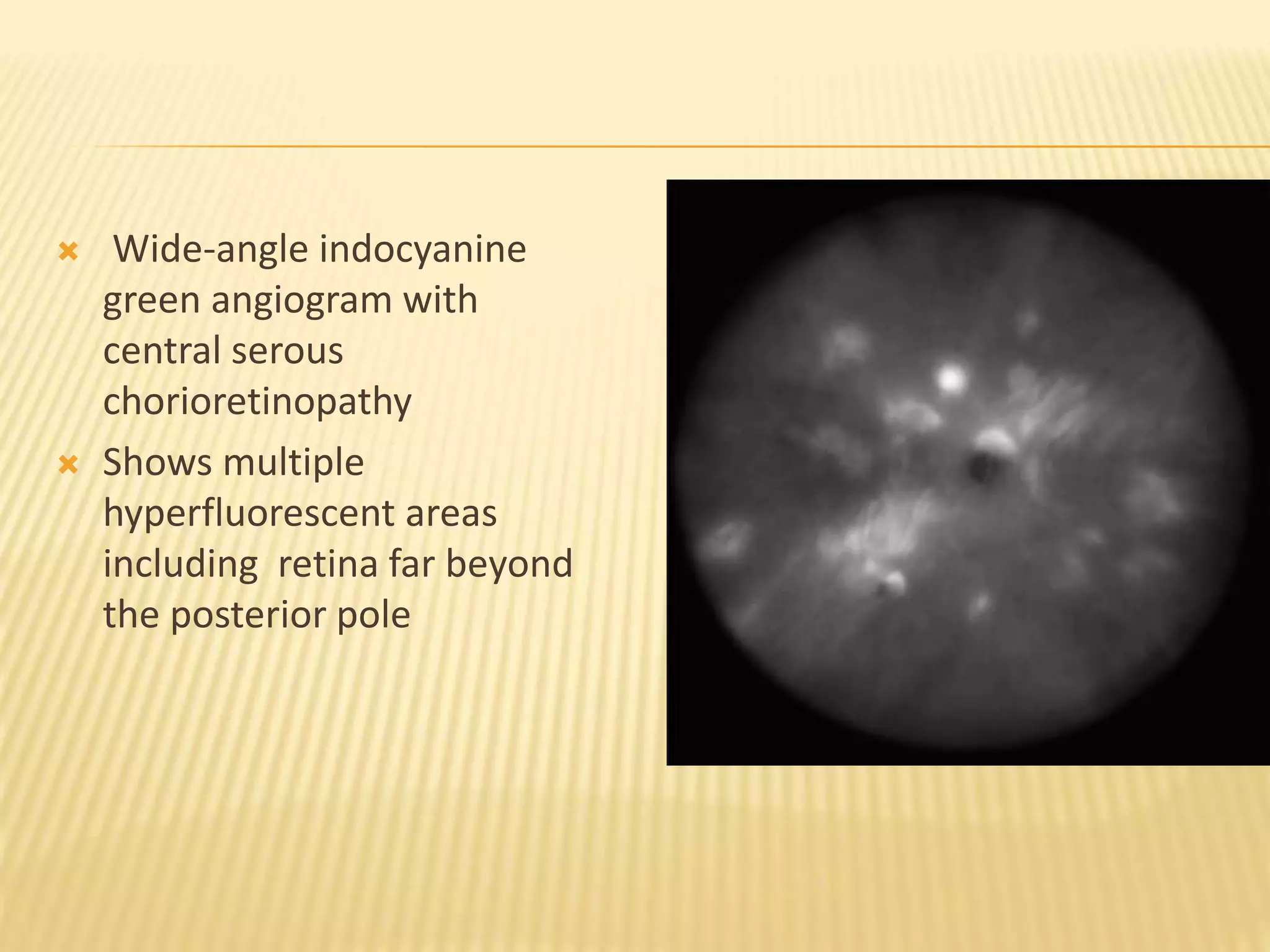 Central serous chorioretinopathy | PPTX | Eye and Vision Conditions ...