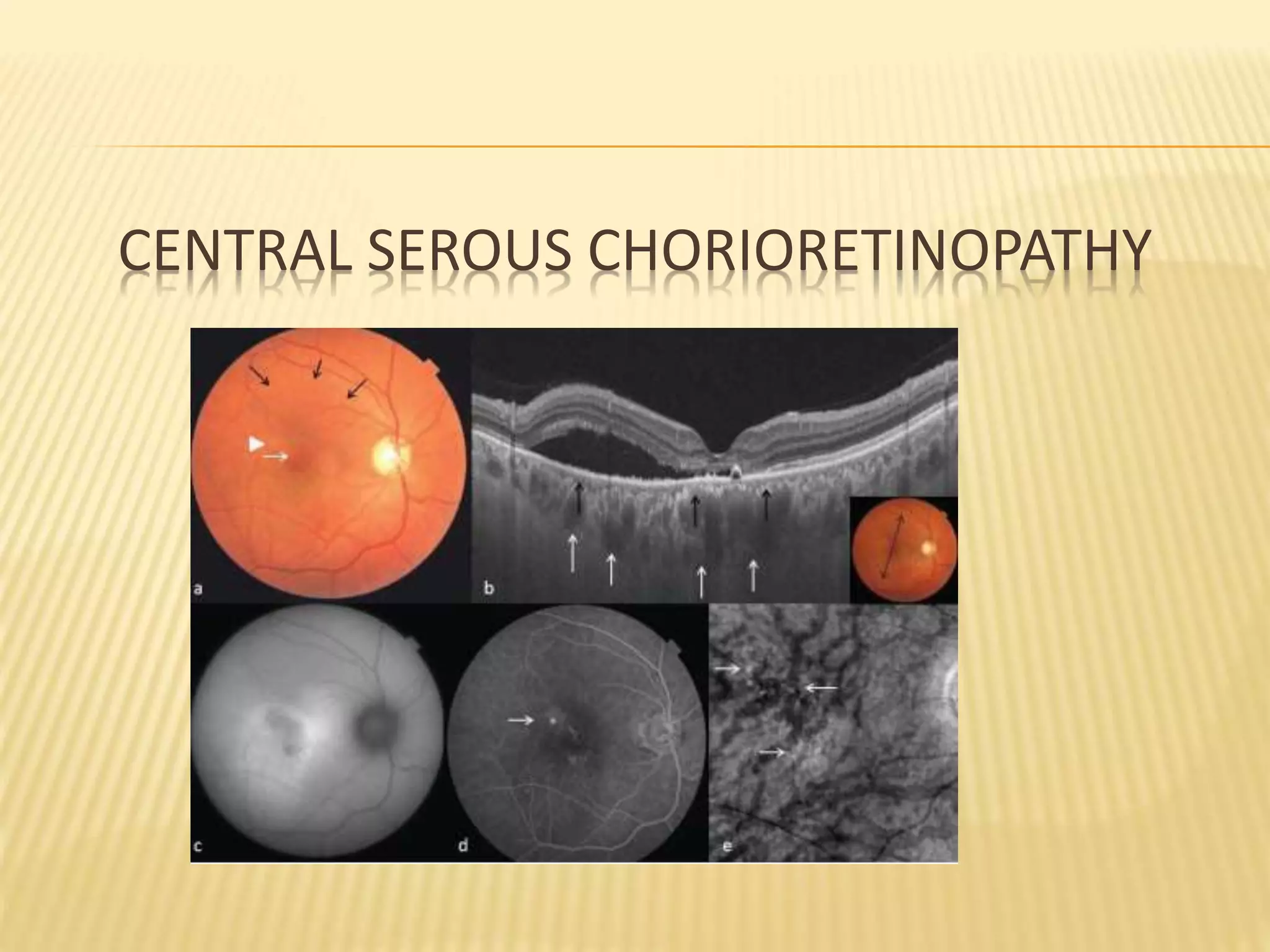 Central serous chorioretinopathy | PPTX