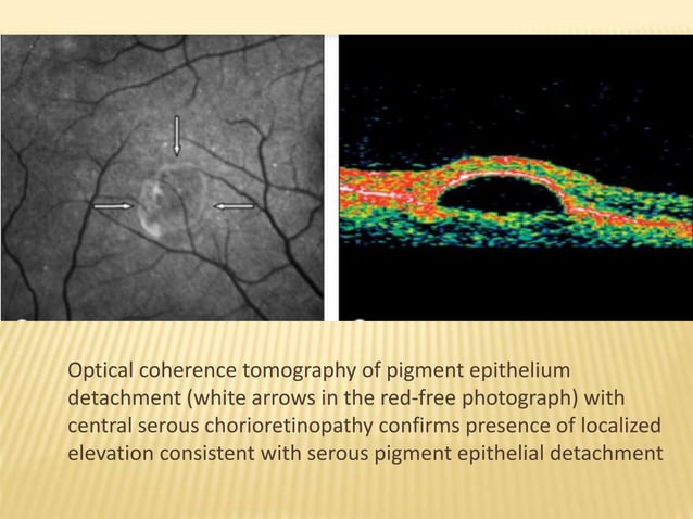 Central serous chorioretinopathy | PPTX | Eye and Vision Conditions ...