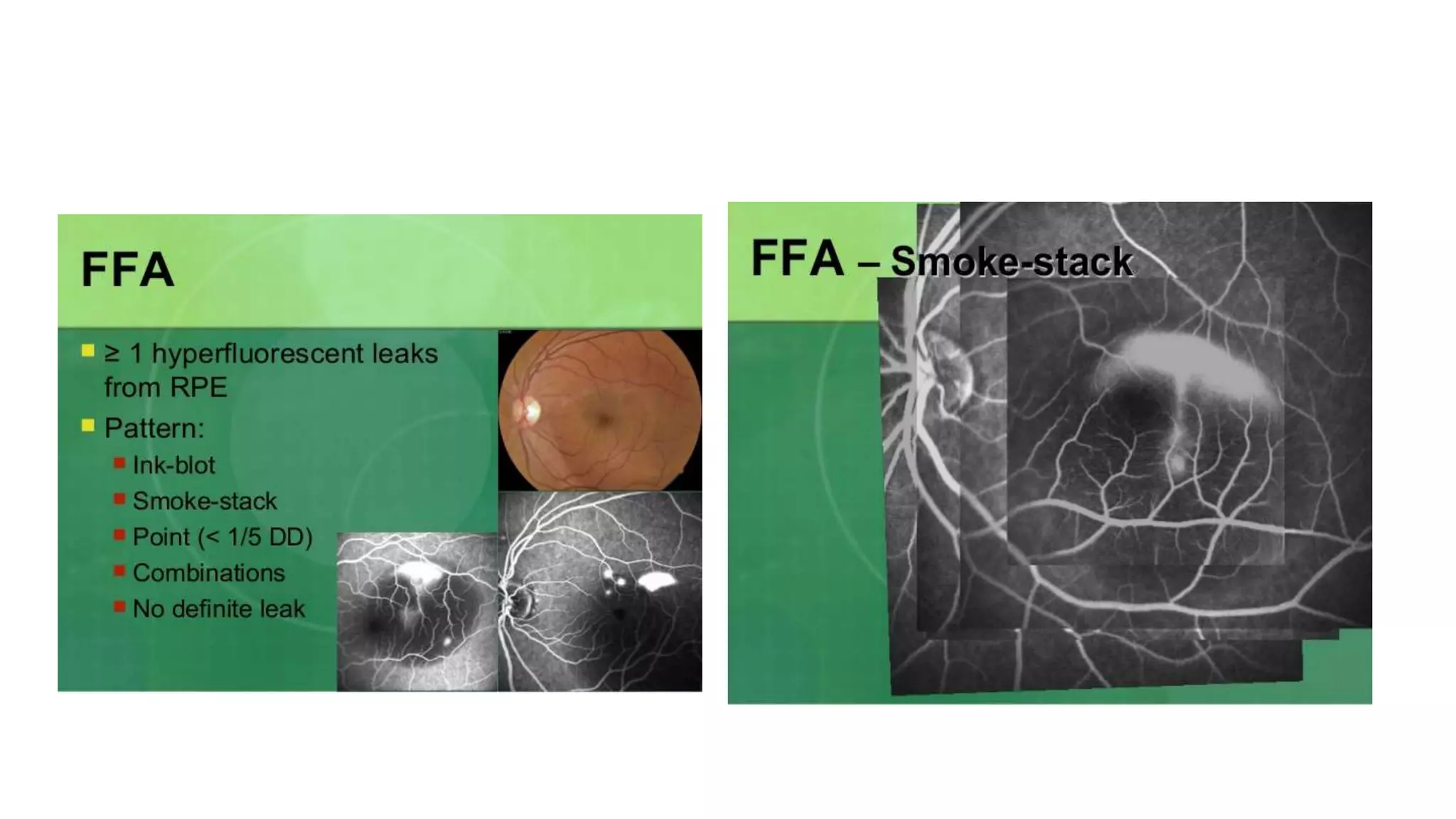 Cscr ( central serous chorioretinopathy ) | PPTX