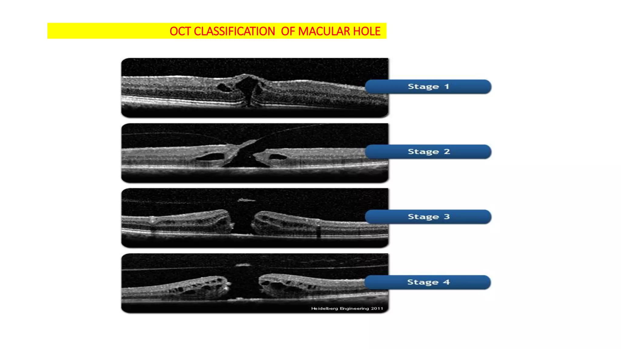 Cscr ( central serous chorioretinopathy ) | PPTX