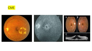 Cscr ( central serous chorioretinopathy ) | PPTX