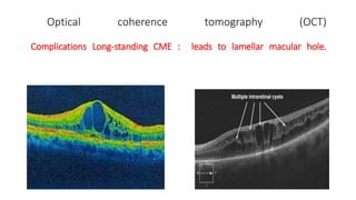 Cscr ( central serous chorioretinopathy ) | PPTX