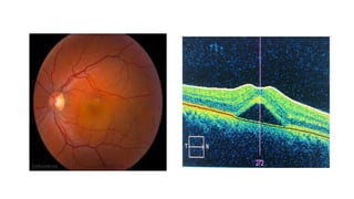 Cscr ( central serous chorioretinopathy ) | PPTX