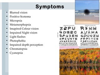 Central Serous Chorioretinopathy Dr Md Ferdous Islam | PPT