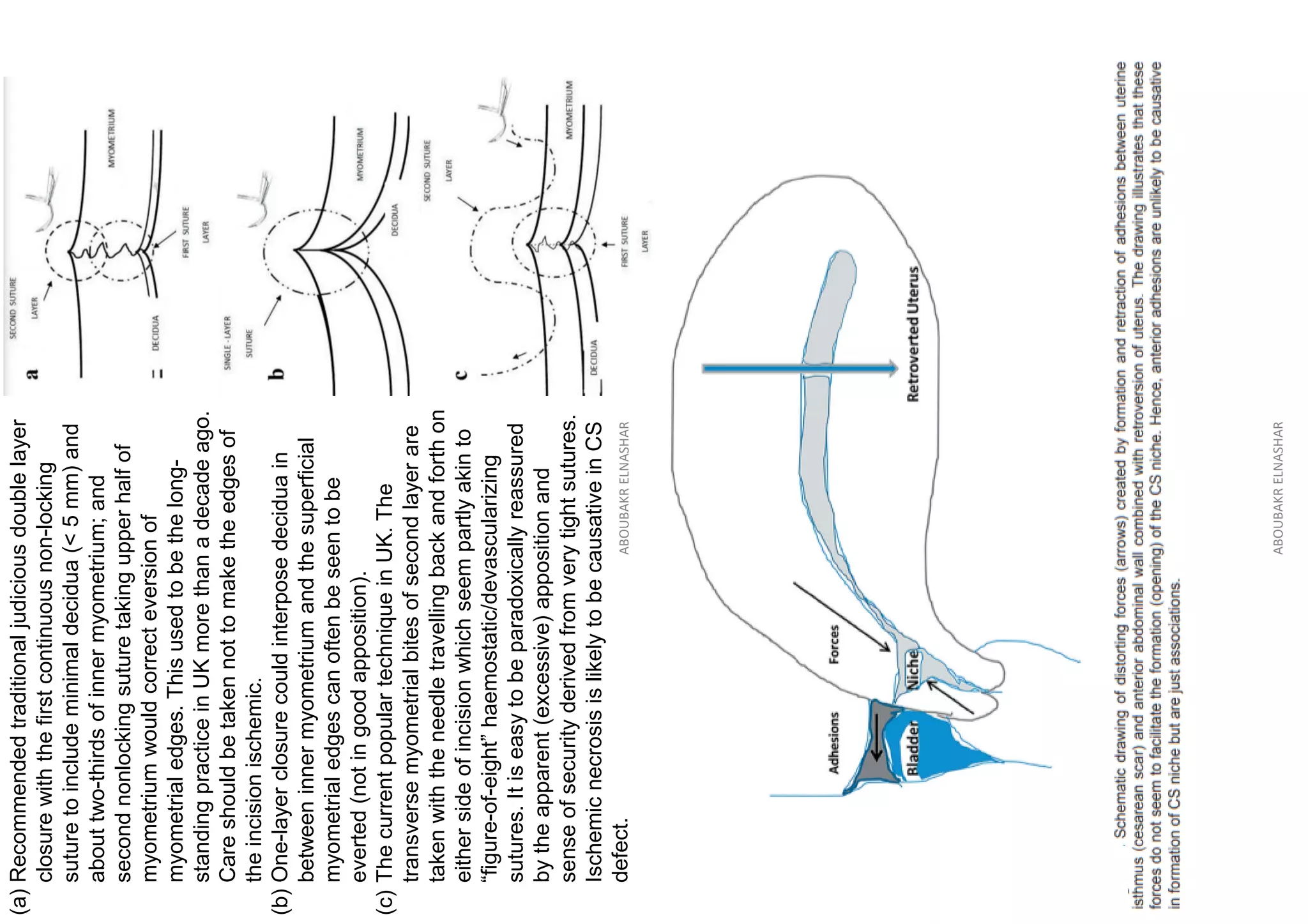 CAESAREAN SCAR DEFECT | PDF