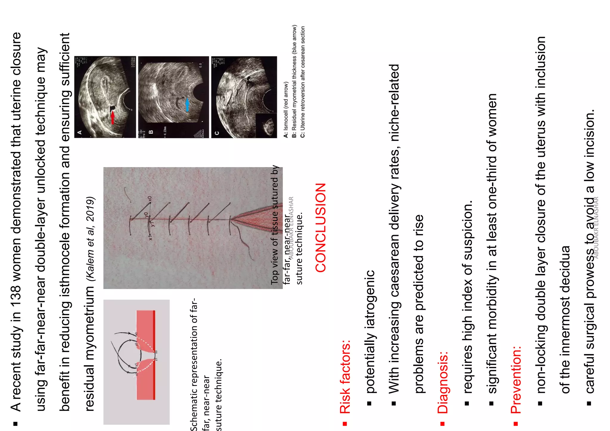 CAESAREAN SCAR DEFECT | PDF