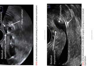 CAESAREAN SCAR DEFECT | PDF