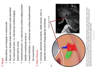 CAESAREAN SCAR DEFECT | PDF