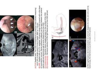 CAESAREAN SCAR DEFECT | PDF