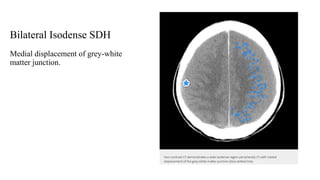 Chronic subdural hematoma brief for neurosurgery | PDF