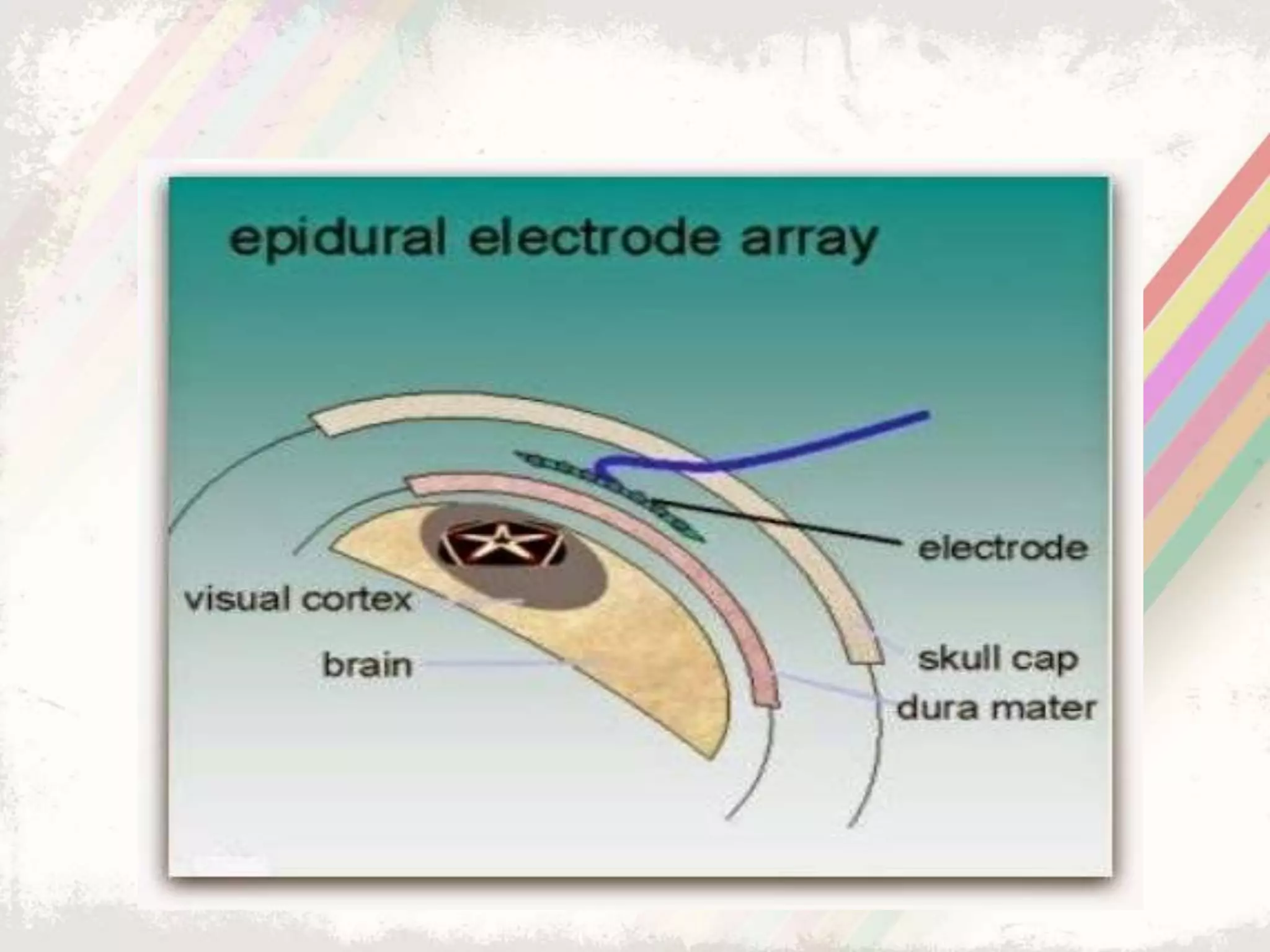 Artificial Eye PPT | PPTX