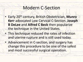 The Brief History of Caesarean Section | PPTX