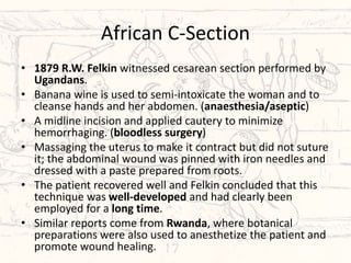 The Brief History of Caesarean Section | PPTX