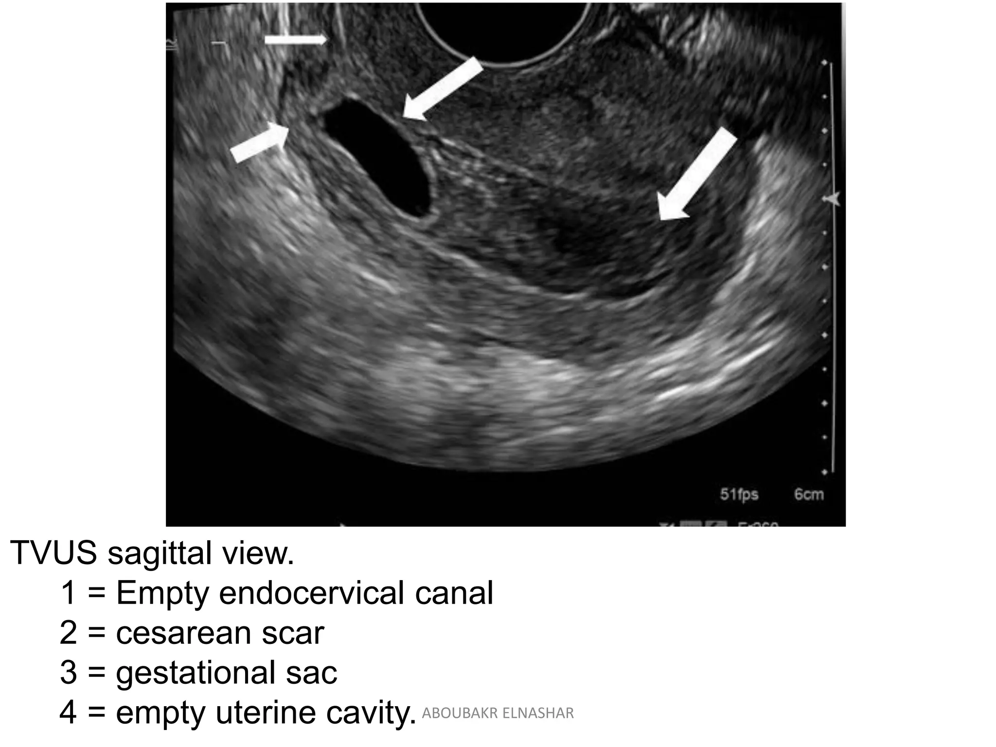 Cesarean Scar Ectopic Pregnancy Current Management Strategies | PDF