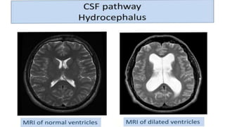 CSF-Pathway all aspect covered (anatomical and physiological) | PPT