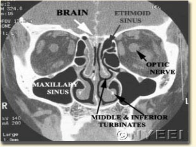 Csf rhinorrhea Surgeries explained
