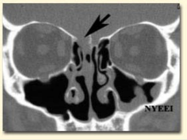 Csf rhinorrhea Surgeries explained