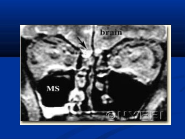 Csf rhinorrhea Surgeries explained