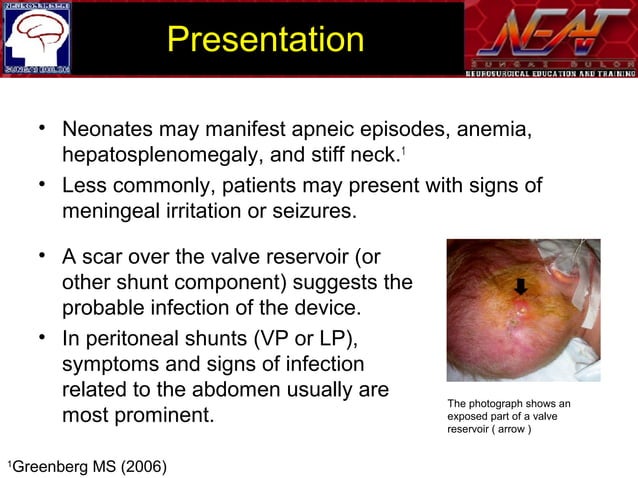 CSF Shunt Infection: Diagnosis and Treatment