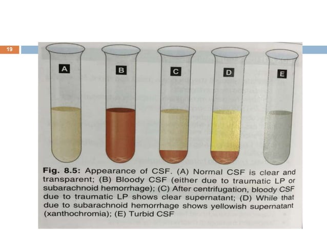 CSF & Body Cavity Fluid Examination.ppt | Brain and Nervous System ...