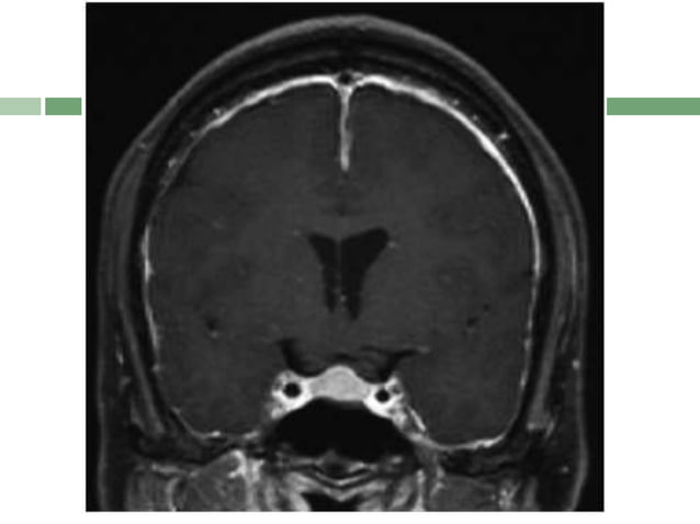 Csf circulation and low csf pressure headaches | PPTX