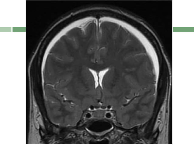 Csf circulation and low csf pressure headaches | PPTX