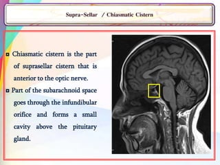 Suprasellar Cisterns