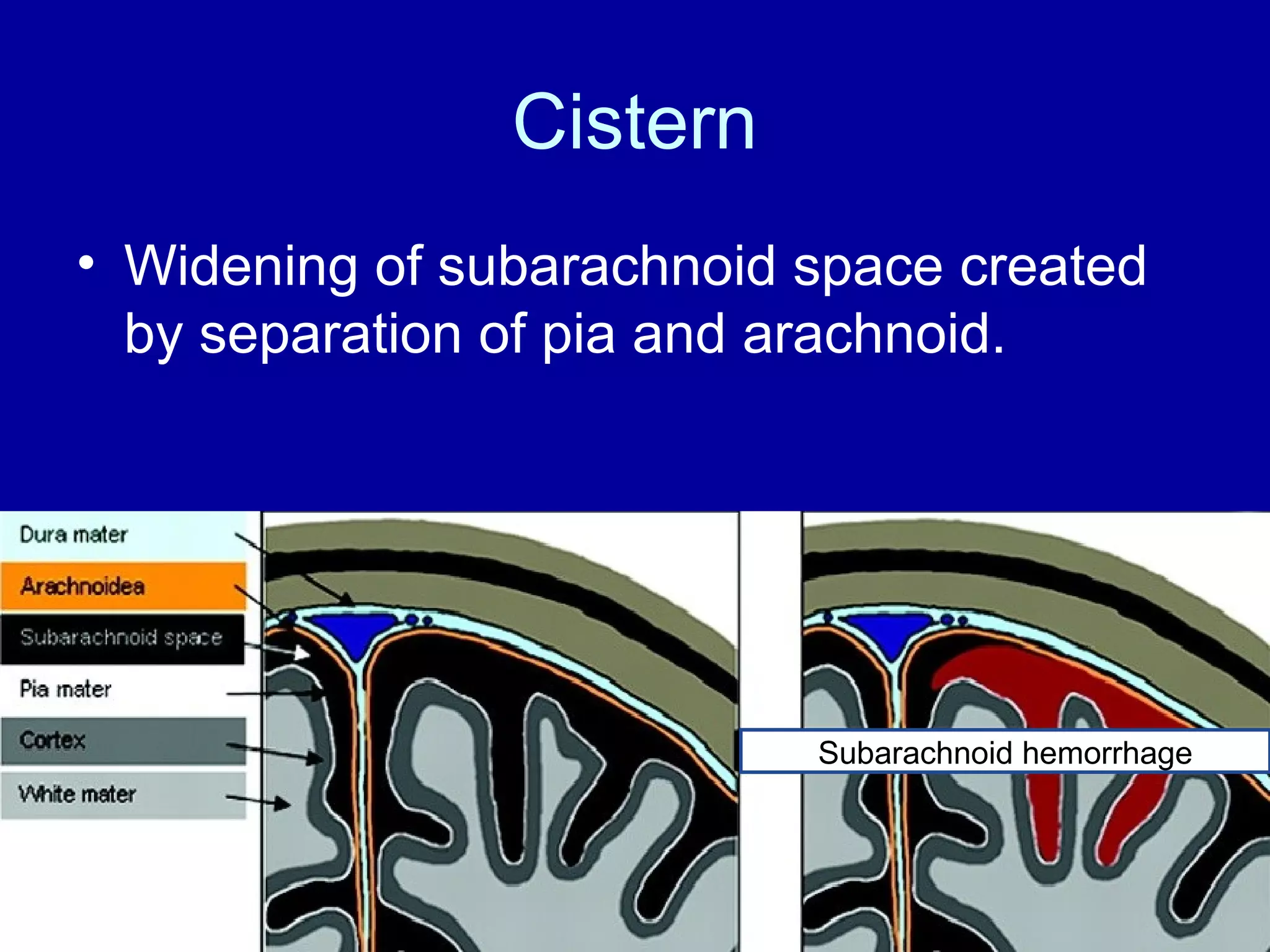 CSF cisterns | PPT