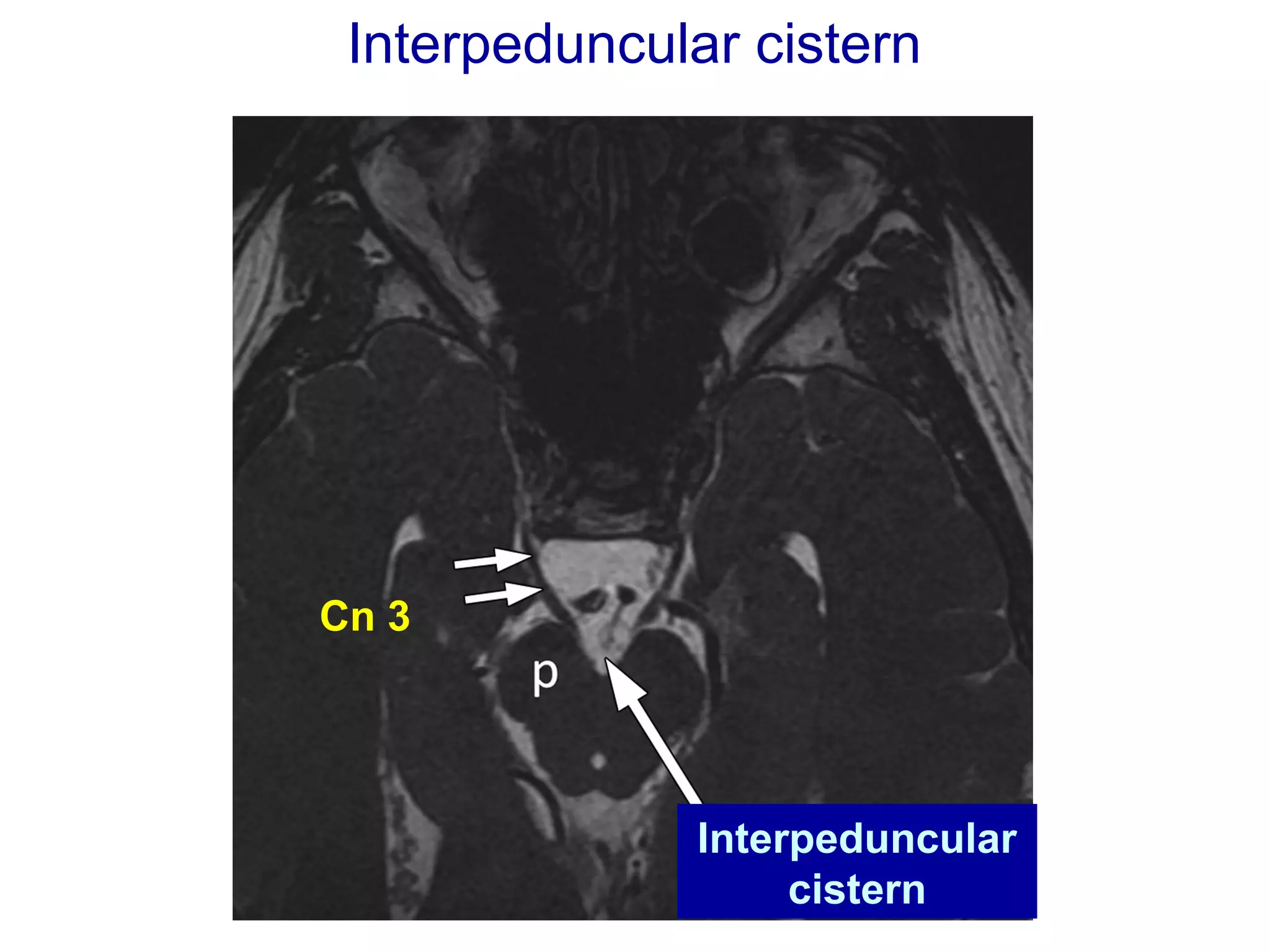 CSF cisterns | PPT