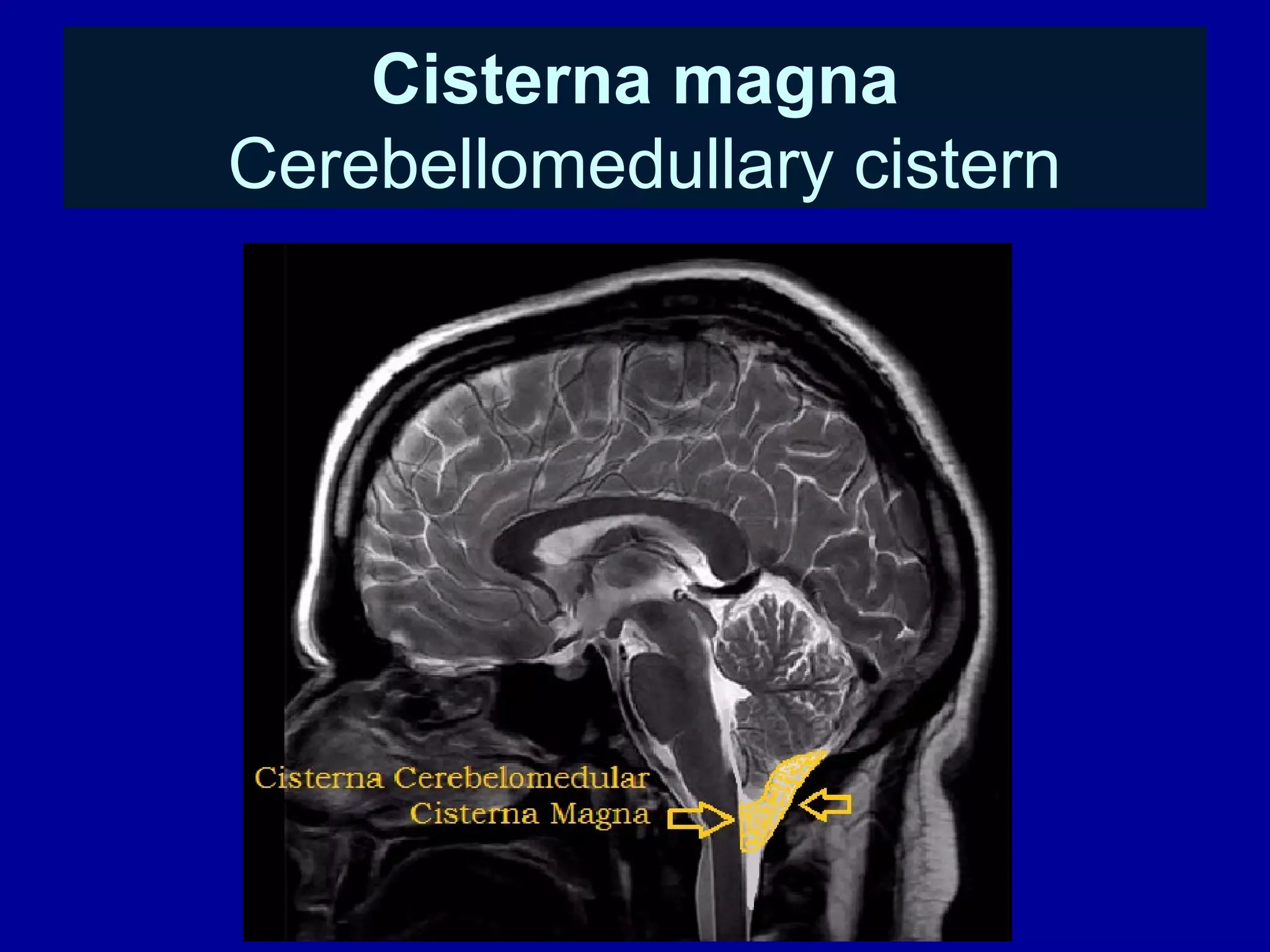 CSF cisterns | PPT