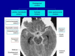 Basal Cistern Effacement