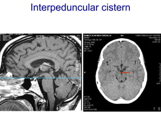 Basal Cisterns Anatomy